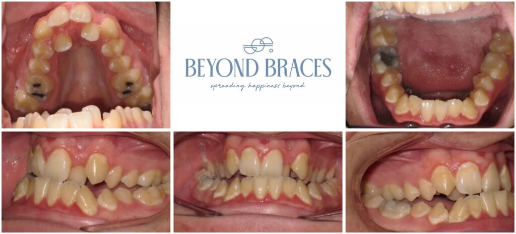 Before and After | Beyond Braces of Sachse Orthodontics